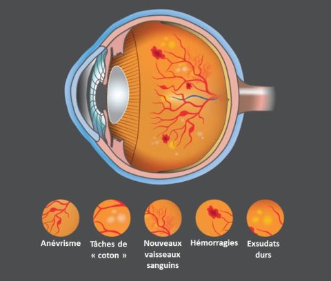 Explication de certaines conditions oculaires | IRIS Mundial